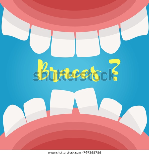 Mouth View Inside Braces Word Vector Stock Vector (Royalty Free ...