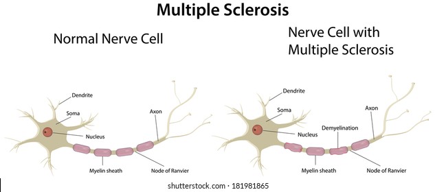 Multiple Sclerosis Labeled Diagram Stock Vector (Royalty Free ...