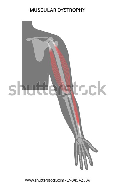 Muscular Dystrophy Concept Disease Human Arm Stock Vector (Royalty Free ...