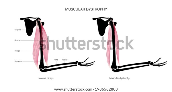 Muscular Dystrophy Concept Disease Human Arm Stock Vector (Royalty Free ...