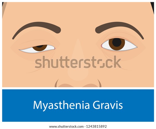 Myasthenia gravis (MG) disease treatment diagnosis test bell palsy exam ... Myasthenia gravis (MG) disease treatment diagnosis test bell palsy exam ...