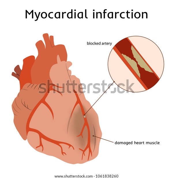 Myocardial Infarction Heart Attack Blocked Artery: เวกเตอร์สต็อก (ปลอด ...