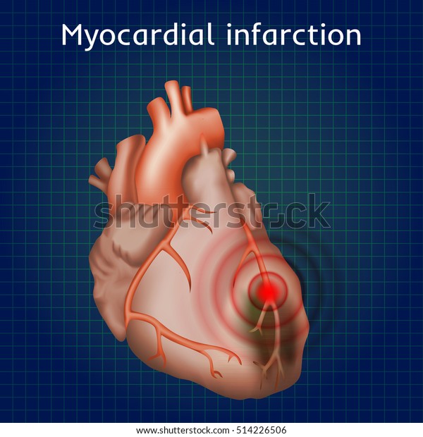 Myocardial Infarction Heart Attack Pain Damaged Stock Vector (Royalty ...