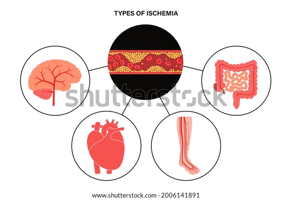 Myocardial Mesenteric Ischemia Brain Stroke Peripheral Stock Vector ...
