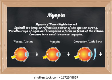 Myopia Vision Disorders Correction Lens Stock Vector (Royalty Free ...