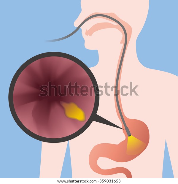 Nasal Endoscope Gastroscopy Vector Illustration Stock Vector (Royalty ...