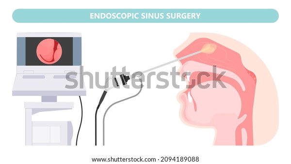 "Endoscopic sinus surgery" - 208 Ảnh, vector và hình chụp có sẵn ...