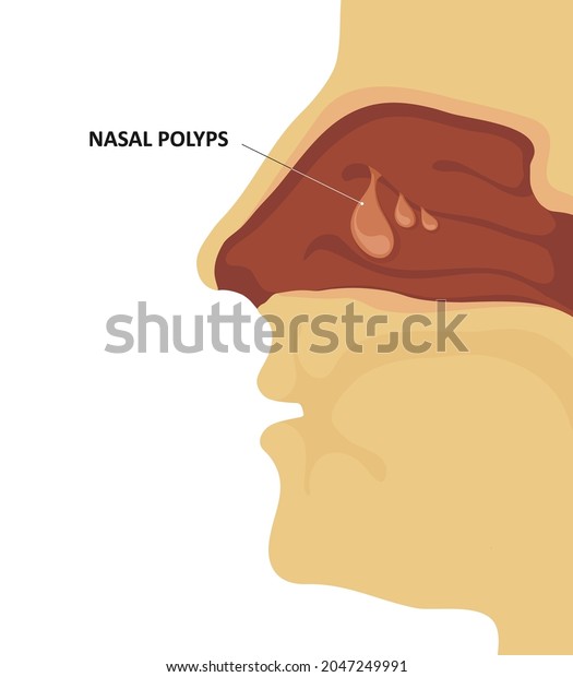 Nasal Polyps Sinus Congestion Vector Illustration Stock Vector (Royalty ...