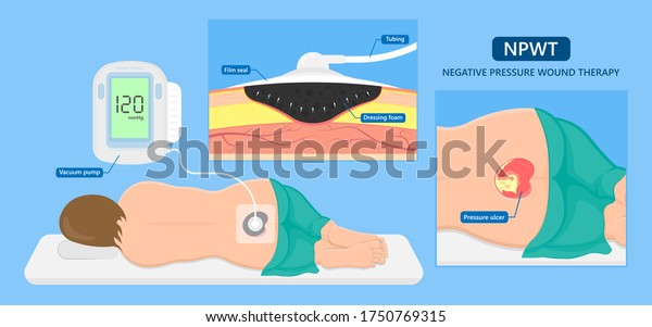 Negative Pressure Wound Therapy Npwt Leg Stock Vector (Royalty Free ...