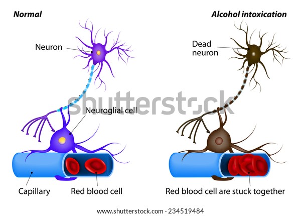 nerve damage caused by heavy drinking. Alcohol dissolves the protective ...