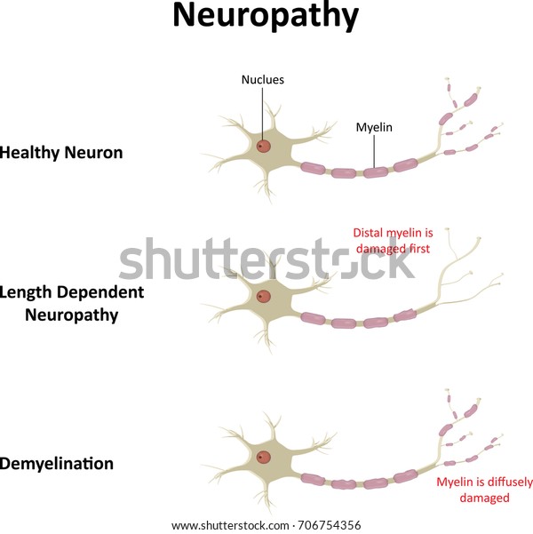 Neuropathy Labelled Illustration 库存矢量图（免版税）706754356 | Shutterstock