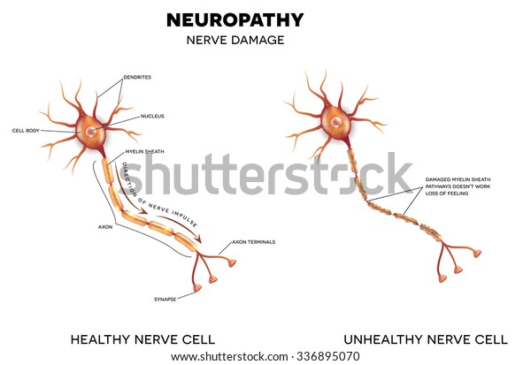 1,067 Neuron Damage Images, Stock Photos & Vectors | Shutterstock