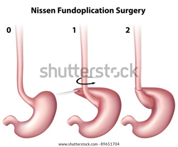 Nissen Fundoplication Stomach Surgery Stock Vector (Royalty Free) 89651704