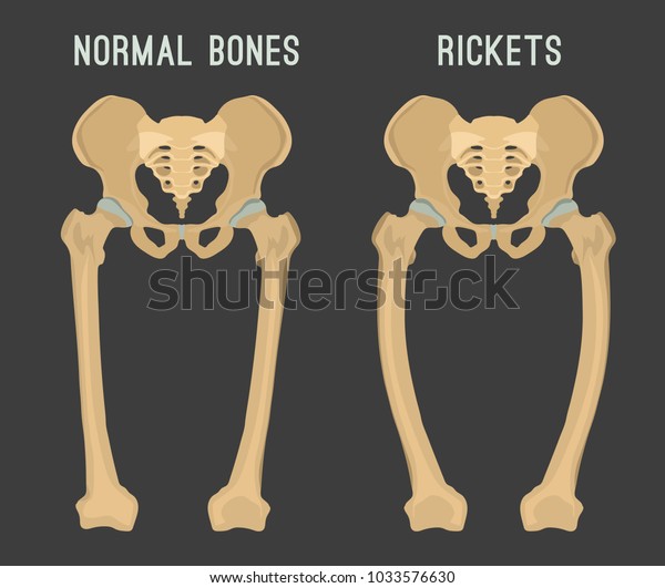 Normal Bones Versus Rickets Osteomalacia Medical Stock Vector (Royalty ...