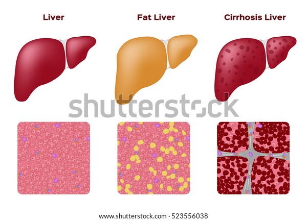 Normal Fatty Cirrhosis Liver Vector Stock Vector (Royalty Free) 523556038