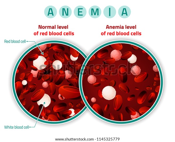 Nivel normal de glóbulos rojos en comparación con el nivel de anemia ...