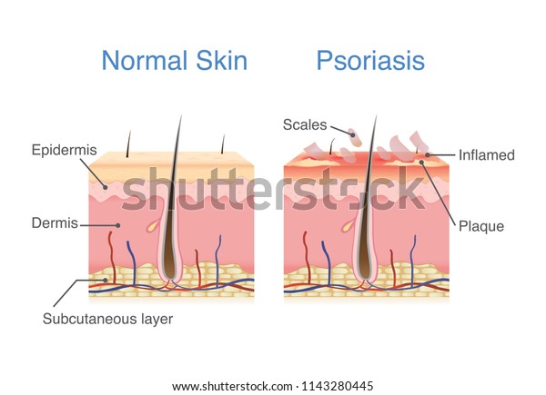 Normal Skin Layer Skin When Plaque Stock Vector (Royalty Free) 1143280445