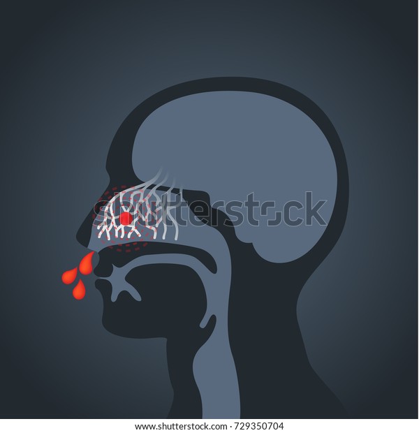 Nosebleed Vector Logo Icon Illustration Stock Vector (Royalty Free ...