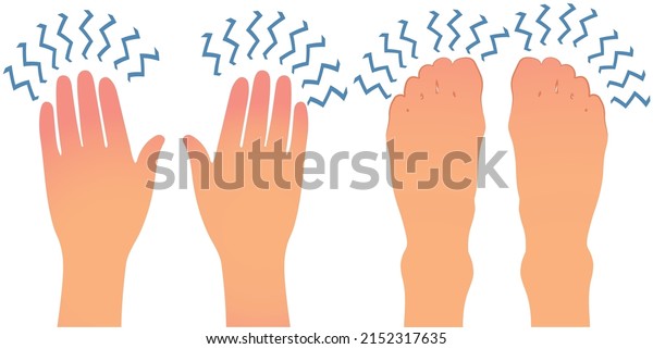 Numbness Hands Feet Concept Vector Illustration Stock Vector (Royalty ...