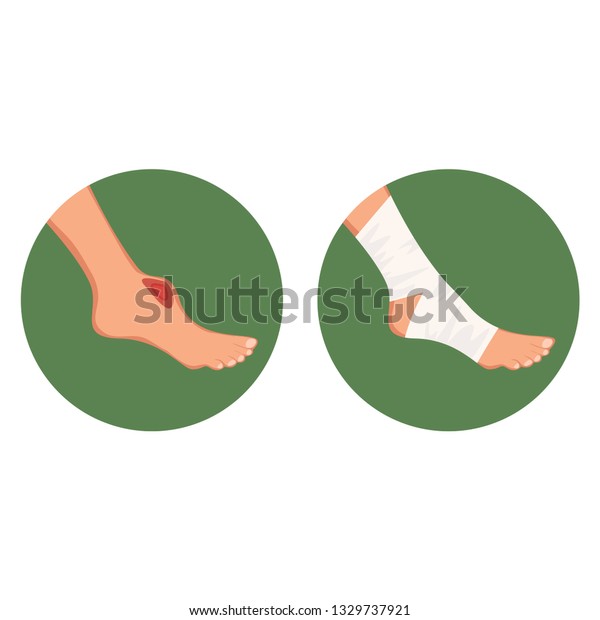 Open Torn Cut Wound Bruised Foot Stock Vector (Royalty Free) 1329737921