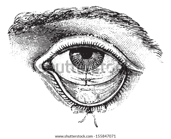Operation Symblepharon Suture Conjunctiva Vintage Engraved Stock Vector ...