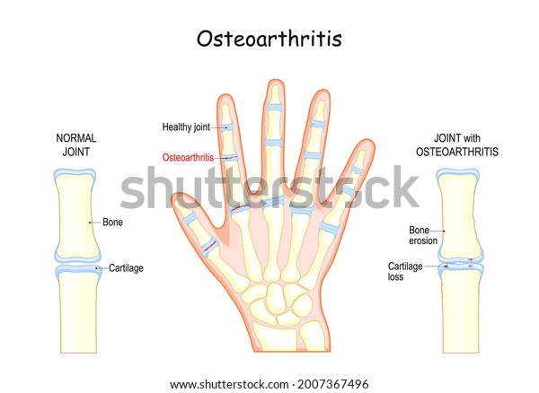 Osteoarthritis Bones Human Hand Closeup Normal Stock Vector (Royalty ...