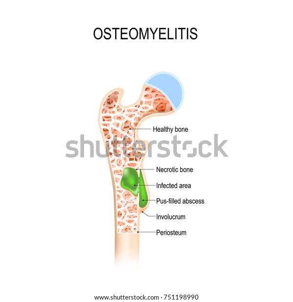 Osteomyelitis Infection Bone Vector Diagram Shows 스톡 벡터(로열티 프리) 751198990