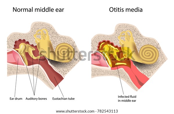 otitis ear anatomy of the human disease