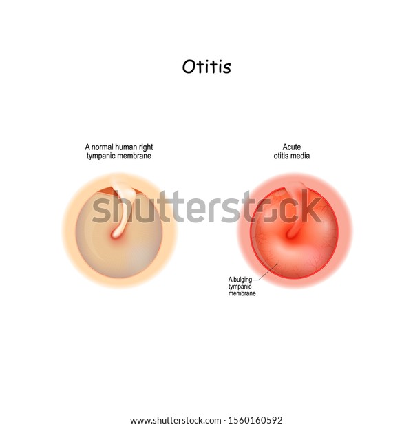 Otitis Healthy Membrane Bulging Tympanic Membrane Stock-vektor ...
