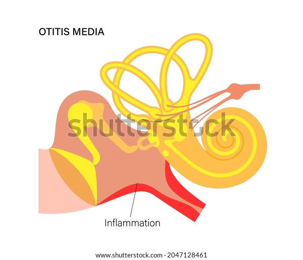Otitis Media Ear Disease Concept Pain Stock Vector (Royalty Free ...