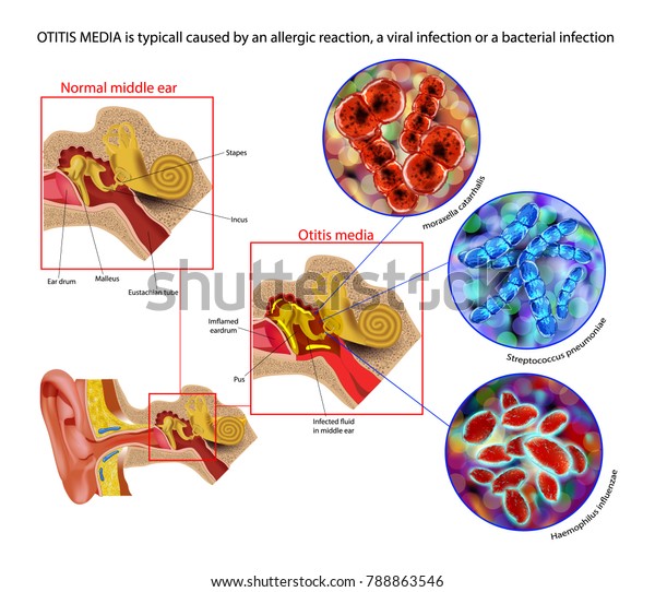 Otitis Media Typicall Caused By Allergic Stock Vector (Royalty Free ...