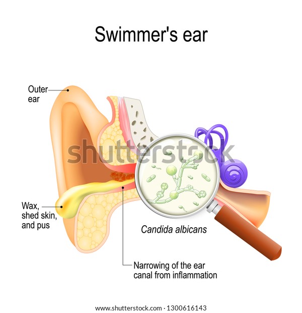 Otitis. swimmer's ear is inflammation of the ear canal and fungal ...