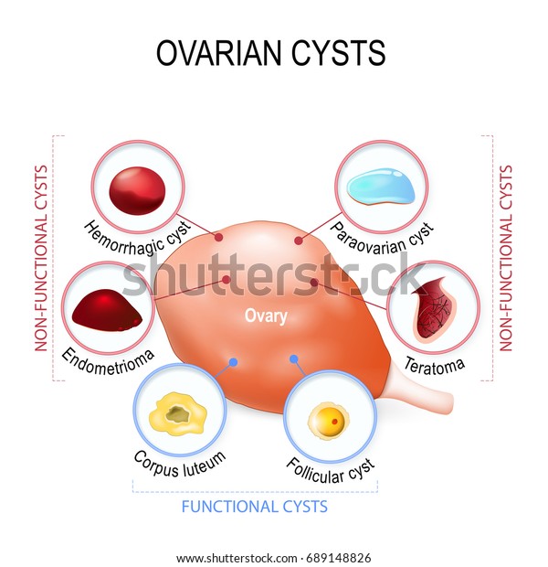 Ovarian Cysts Stock Vector (Royalty Free) 689148826