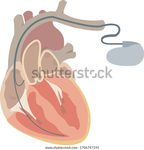 Pacemaker Dual Chamber Pacemaker Diagram Stock Vector (Royalty Free ...