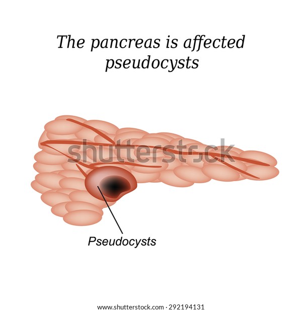 Pancreas Pseudocyst Affected Vector Illustration On Stock Vector ...