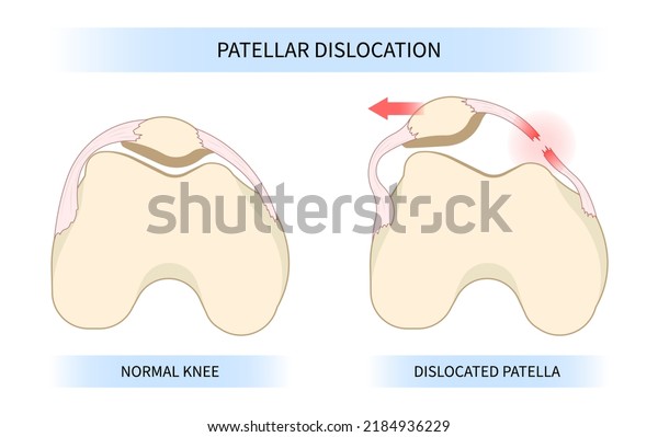 Patellar Dislocated Subluxation Patella Dysplasia Painful: เวกเตอร์ ...