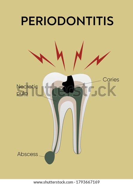 Patient Education Poster Showing Process Caries Stock Vector (Royalty ...
