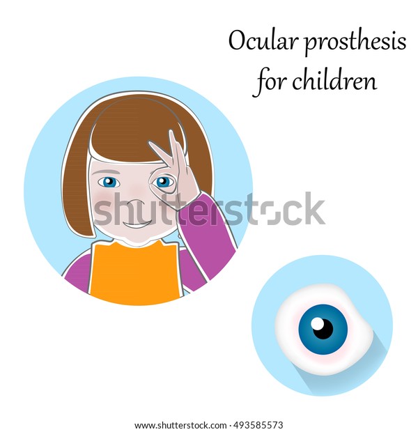 Pediatric Ocular Prostheses Illustration Prosthetic Artificial Stock ...
