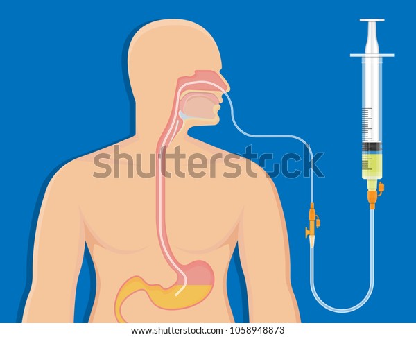 Peg Gastric Nasojejunal Orogastric Inserted Nasoduodenal Stock Vector ...