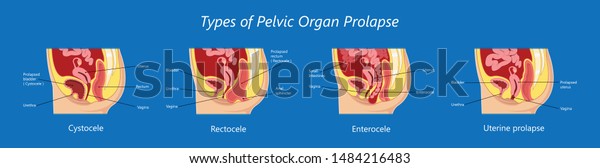 Pelvic Floor Prolapse Type Uterine Uterus Stock Vector (Royalty Free ...