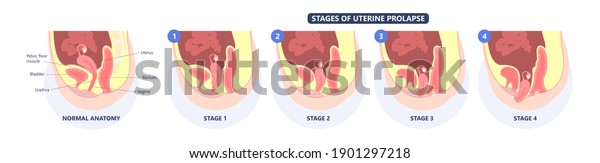 Pelvic Floor Prolapse Type Uterine Uterus Stock Vector (Royalty Free ...