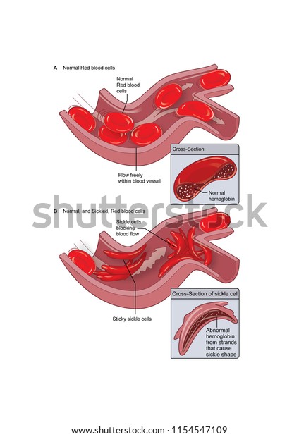 People Scd Have Abnormal Hemoglobin Called Stock Vector (Royalty Free ...