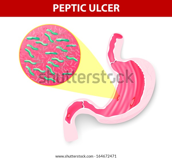 Peptic Ulcer Sore On Lining Stomach Stock Vector (Royalty Free ...