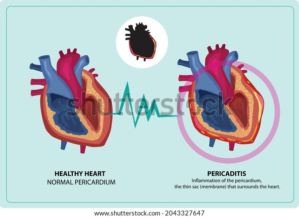 Pericarditis Inflammation Outer Lining Heart Editable Stock Vector ...