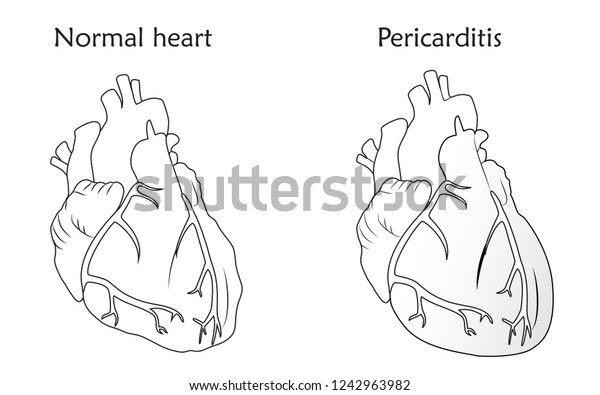 Pericarditis Inflammation Pericardium Damaged Normal Heart: vector de ...
