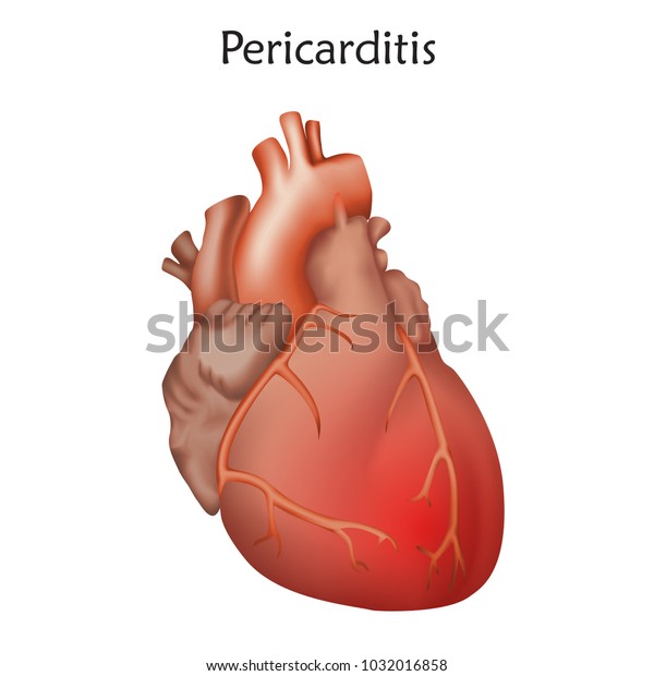 Pericarditis Inflammation Pericardium Pericarditis Inflammation ...