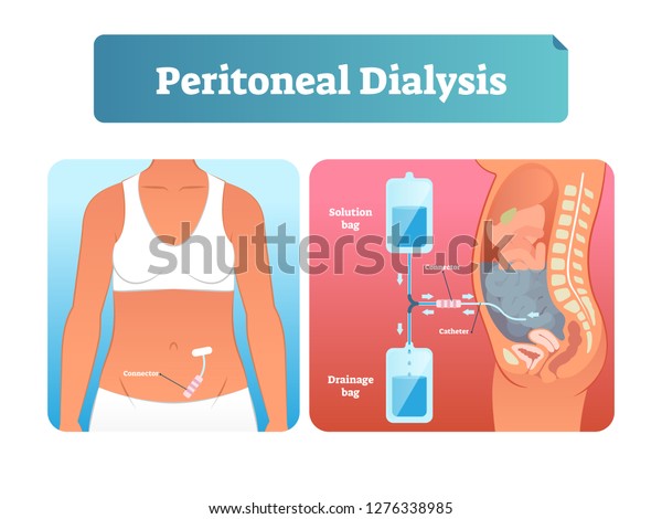 Peritoneal Dialysis Vector Illustration Labeled Scheme Stock-vektor ...