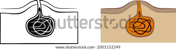 Pilonidal Cyst Icon Vector Illustration Stock Vector (Royalty Free ...