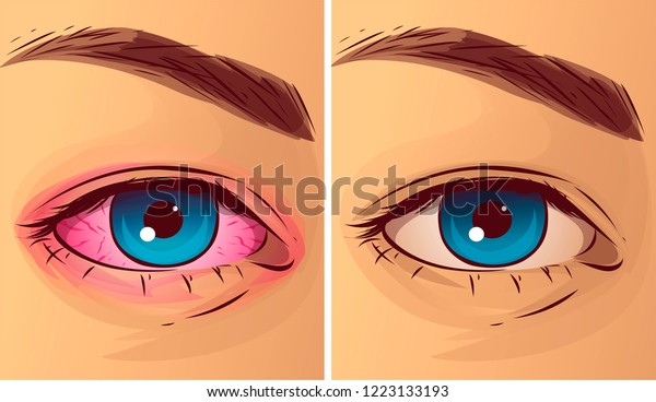 Pink Eye Beforeafter Vector Illustration Stock Vector (Royalty Free ...
