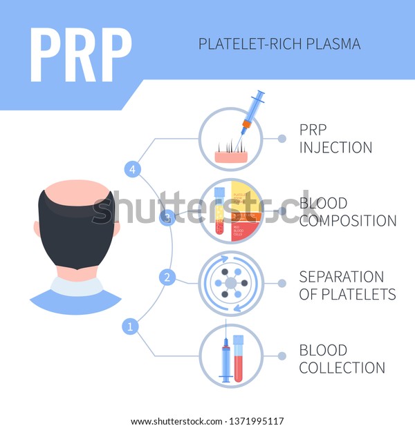 Platelet Rich Plasma Injection Procedure Prp Stok Vektör (Telifsiz ...